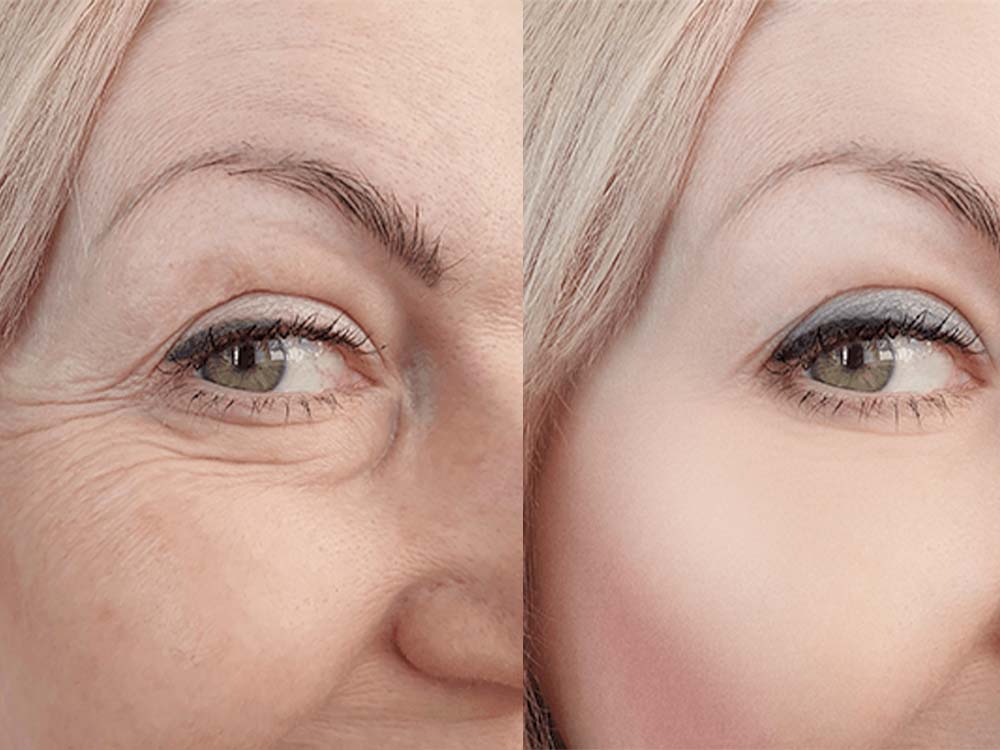 Glov Beauty Micro Infusion Facial System + 3 Serum - Microneedling At ...